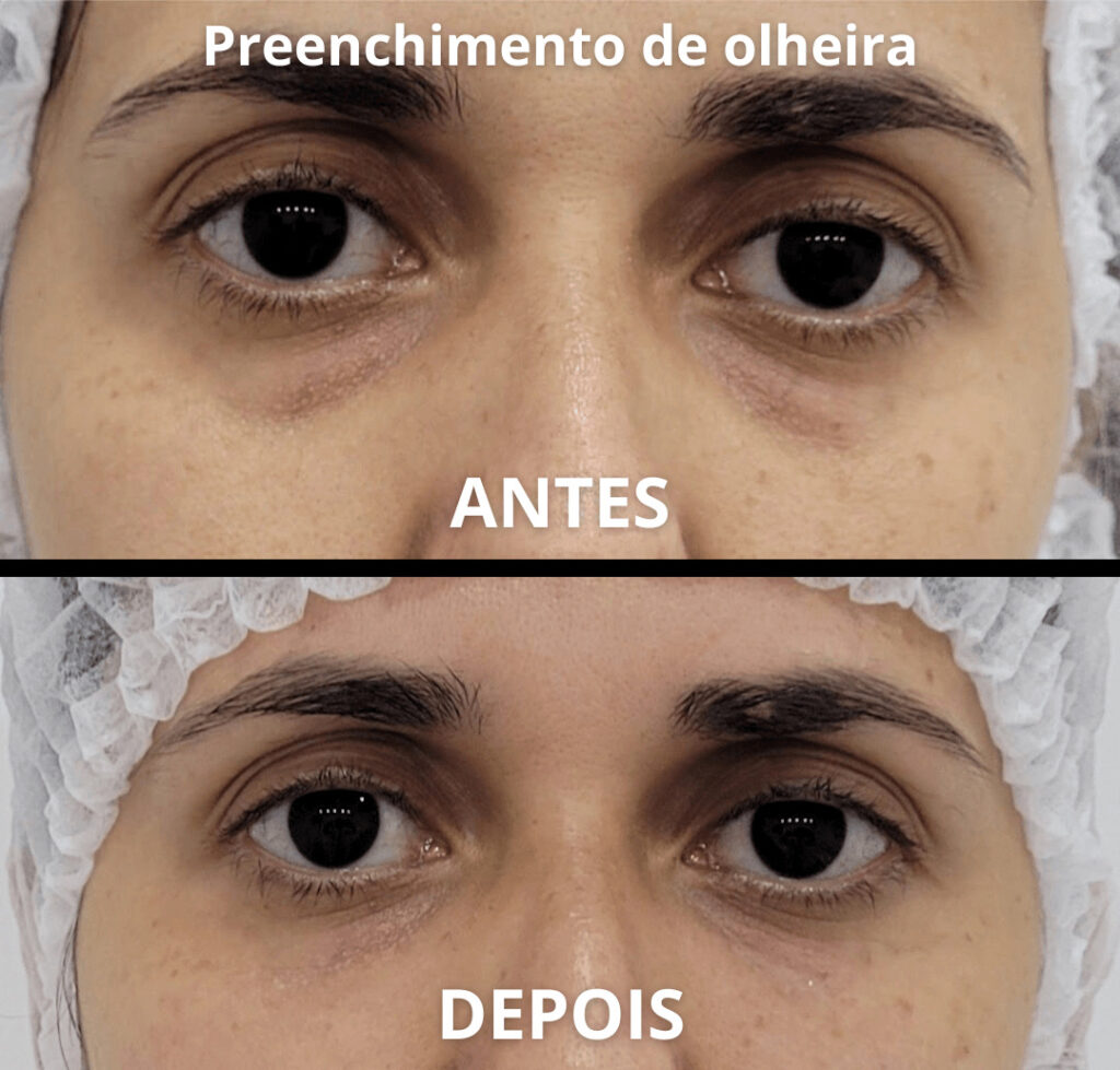 Preenchimento Com Ácido Hialurônico Dra Érica Barros